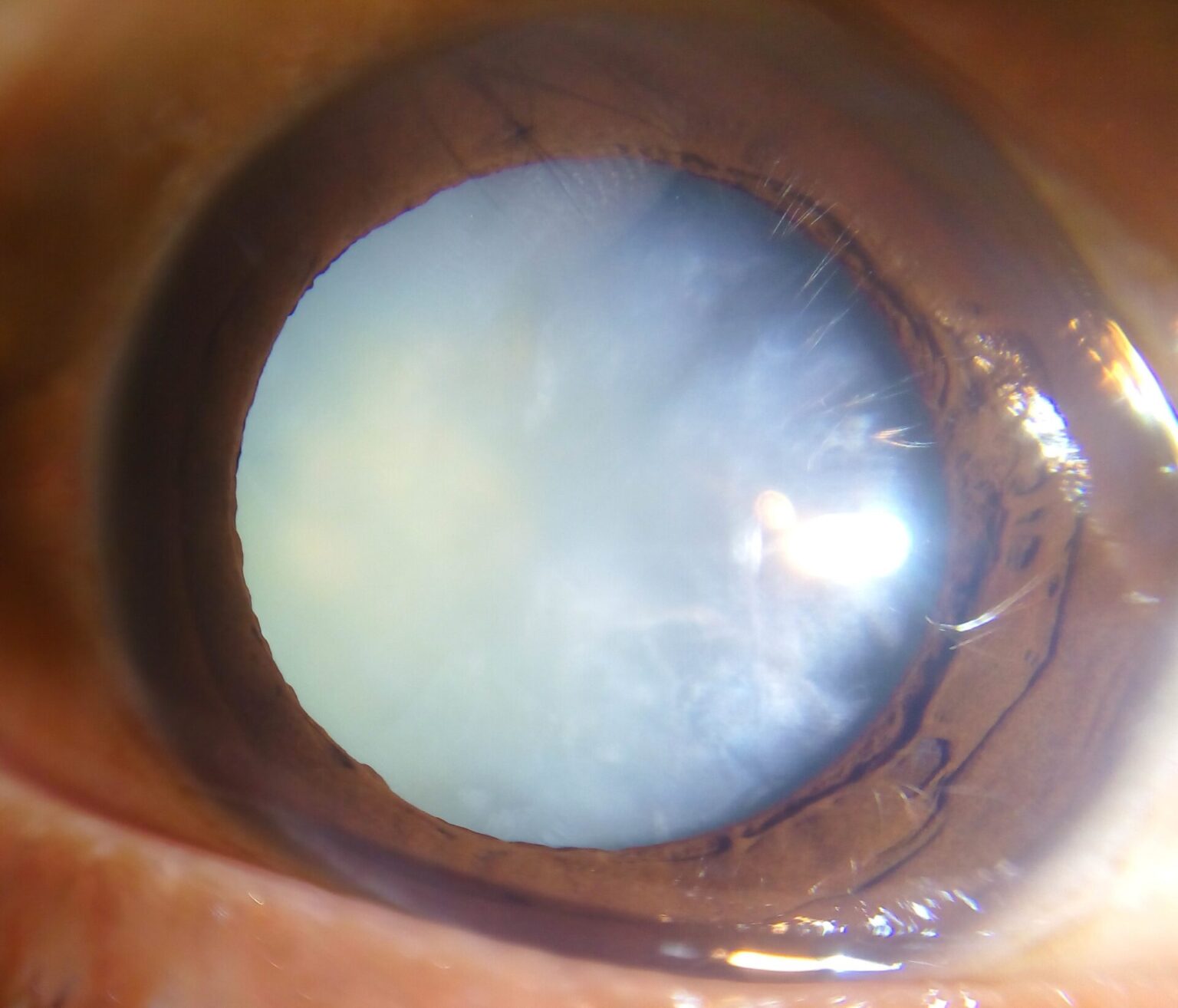 Cataracts: A Common Cause of Vision Loss