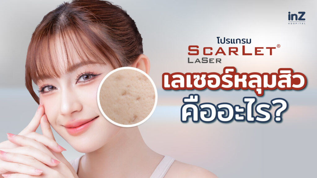 โปรแกรม Scarlet Laser ทางออกของคนมีหลุมสิว กู้ผิวเรียบเนียน